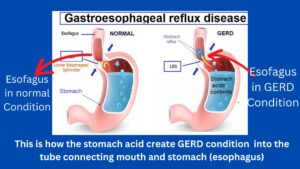 ICD 10 for GERD (2025)