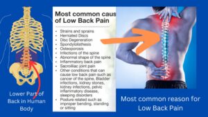 ICD 10 Code For Low Back Pain